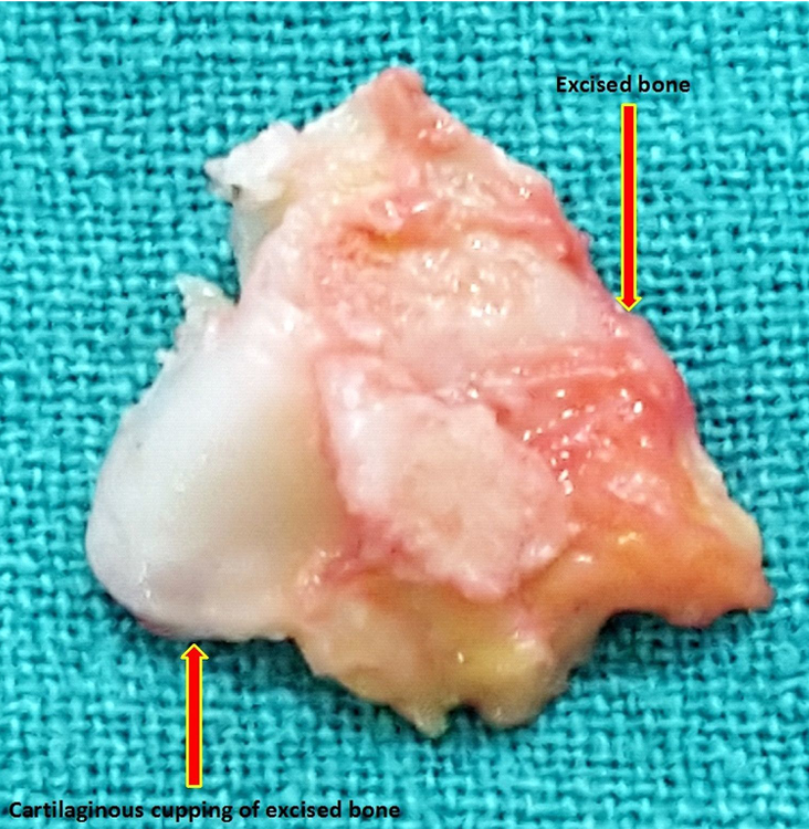 Haglund씨 변형으로 인한 수술과 재활운동 : 네이버 블로그