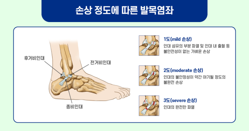 자주 발목 삐고 발목통증 있다면 발목염좌 And 발목관절염 주의 네이버 블로그
