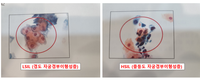ASCUS, LSIL과 HSIL, ASC-H 치료방침의 차이 : 네이버 블로그