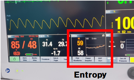 마취심도 모니터링 (BIS /ENTROPY/마시모 SEDLINE) +TOF : 네이버 블로그