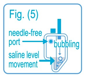 SINAPI Chest Bottle(시나피 체스트 보틀)에 대한 모든것(설명, 적응증, 설치, 장점, 임상적용) : 네이버 블로그