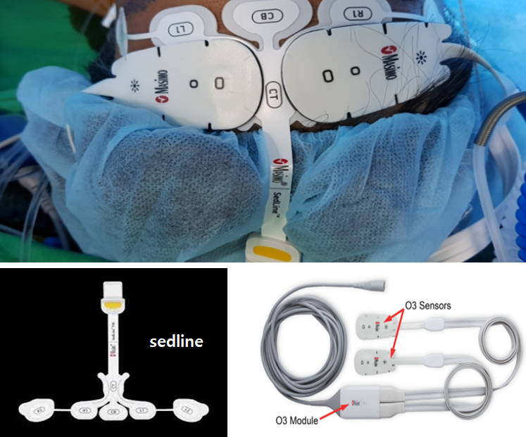 마취심도 모니터링 (BIS /ENTROPY/마시모 SEDLINE) +TOF : 네이버 블로그