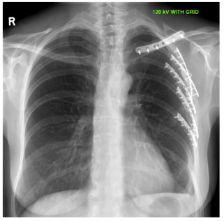 갈비뼈 골절; 석고 붕대로 고정을 할 수 없다 : 네이버 블로그