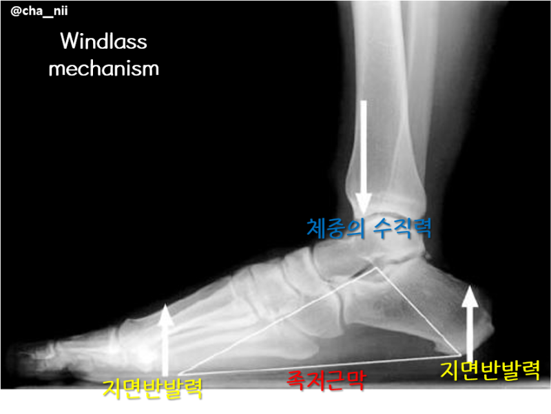 평발, 요족, 족저근막염은 반드시 알아두어야 하는 윈들라스 메커니즘 (Windlass mechanism) !! : 네이버 블로그