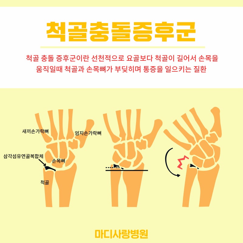 청주손목통증 척골충돌증후군 의심이 된다면 네이버 블로그
