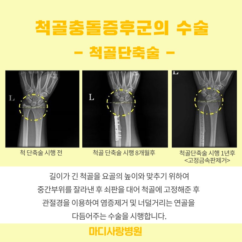 청주손목통증 척골충돌증후군 의심이 된다면 네이버 블로그