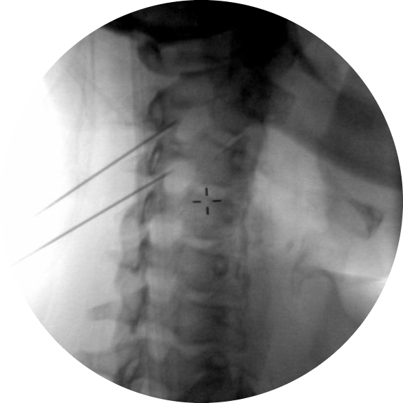 Cervical selective nerve root block (SNRB) : 네이버 블로그