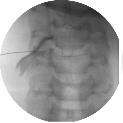 Cervical selective nerve root block (SNRB) : 네이버 블로그