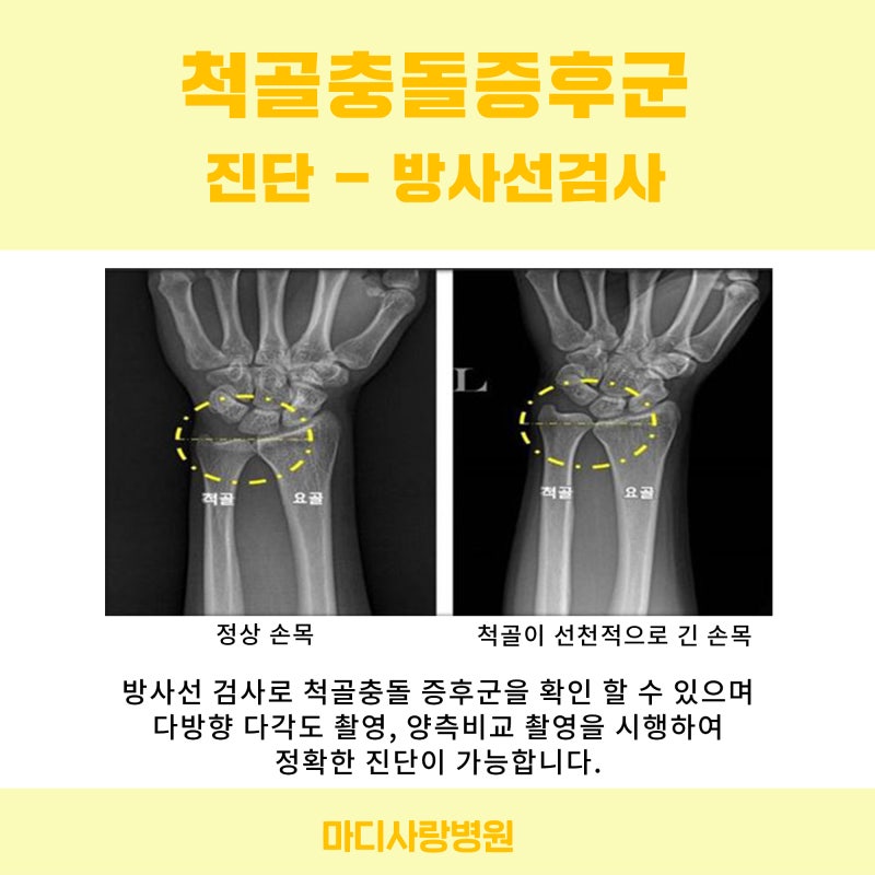 청주손목통증 척골충돌증후군 의심이 된다면 네이버 블로그