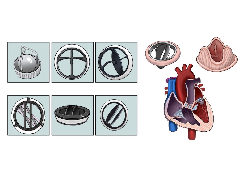 승모판 기능부전 증상 원인 치료 방법 알아보자mitral Valve Insufficiency 네이버 블로그