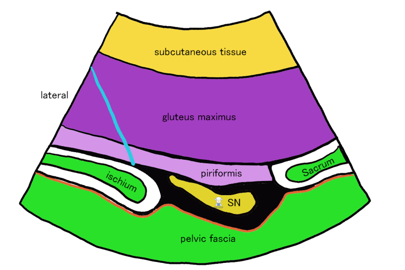 좌골신경통 이상근증후근 골반통 신경치료 parasacral ischial plane block 좌골신경차단술 PIP : 네이버 블로그