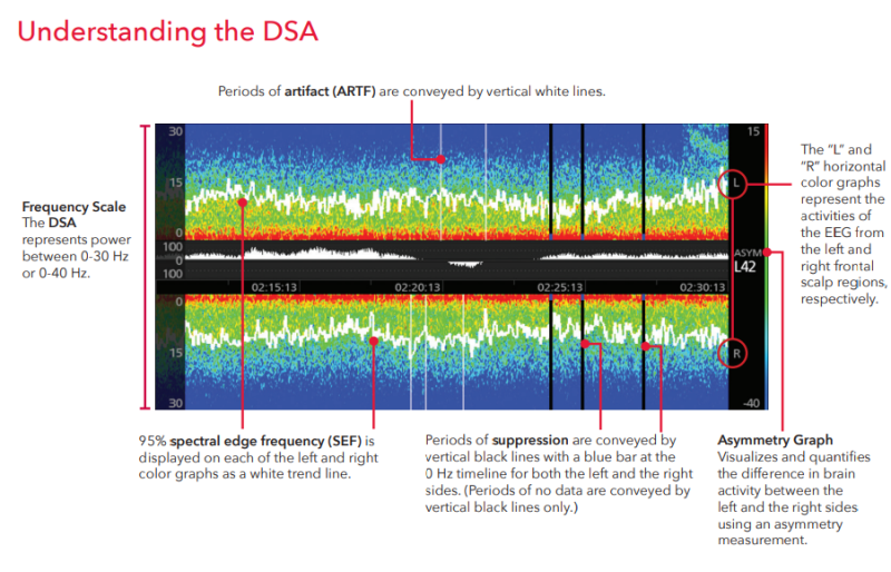 마취심도 모니터링 (BIS /ENTROPY/마시모 SEDLINE) +TOF : 네이버 블로그