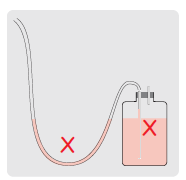 SINAPI Chest Bottle(시나피 체스트 보틀)에 대한 모든것(설명, 적응증, 설치, 장점, 임상적용) : 네이버 블로그
