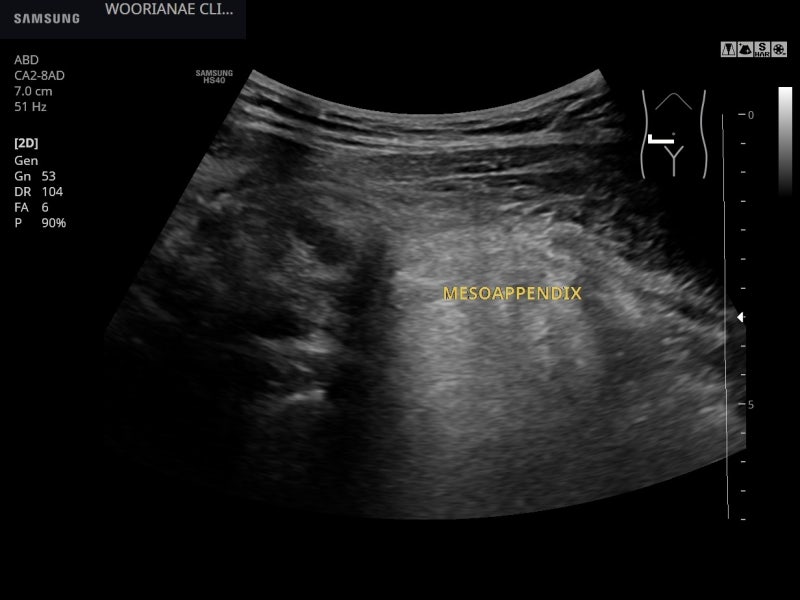 우하복부 통증으로 내원 일부 천공 소견을 보이는 충수돌기염 동대문구 답십리 장안동 우리안애 우리안愛 내과 네이버 블로그