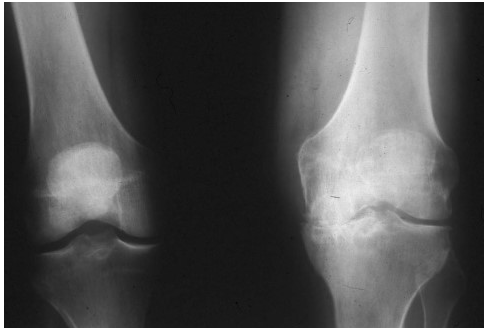 [무릎] Pigmented Villo-nodular Synovitis (PVNS) 색소 융모 결절성 활막염 : ★반복적 혈관절증 ...