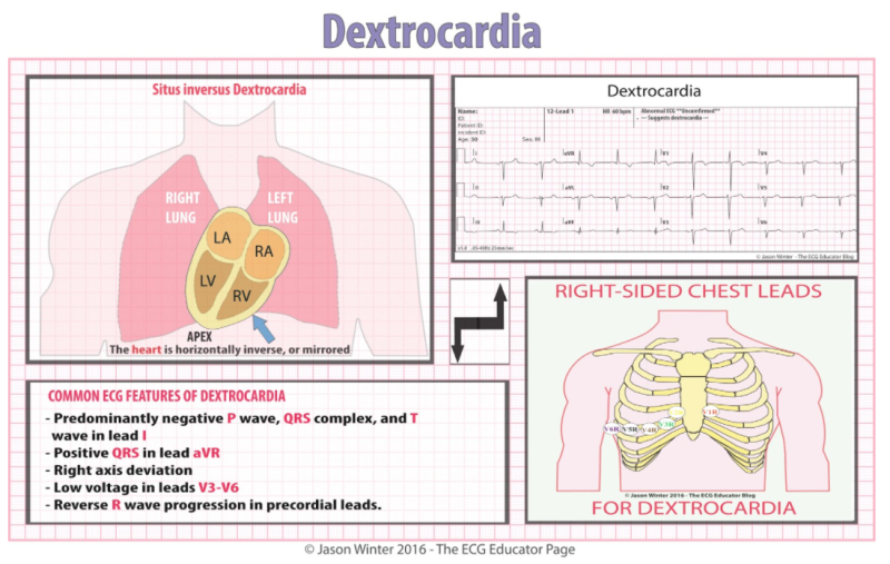 심전도, 우심증 (Dextrocardia) : 네이버 블로그