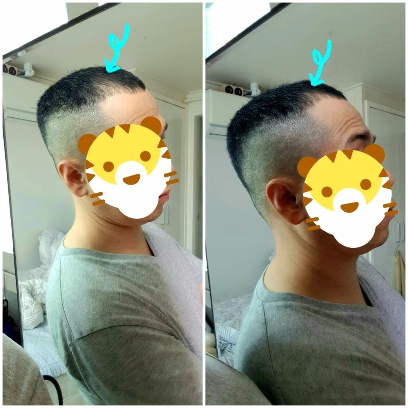 유전엠자탈모 치료제 아보다트복용 1년후 솔직후기탈모치료제는 아보다트추천 네이버 블로그