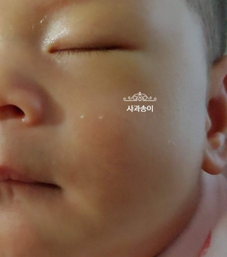 신생아 비립종과 좁쌀여드름 원인과 관리방법 잘못하면 흉터가 남아요 네이버 블로그