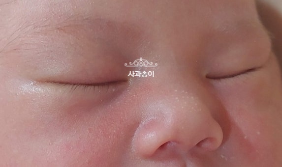 신생아 비립종과 좁쌀여드름 원인과 관리방법 잘못하면 흉터가 남아요 네이버 블로그