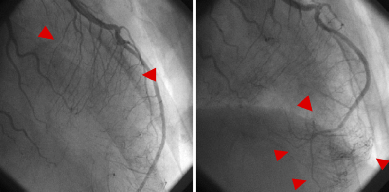 LAD, LCX, RCA 구분하는 법 ; coronary angiograpy 보는 법 : 네이버 블로그