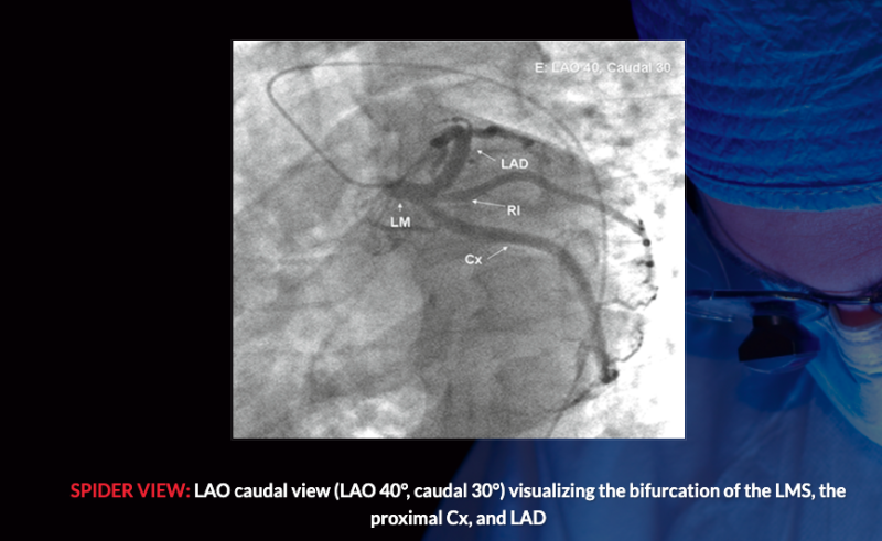 LAD, LCX, RCA 구분하는 법 ; coronary angiograpy 보는 법 : 네이버 블로그
