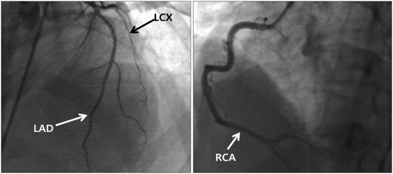 LAD, LCX, RCA 구분하는 법 ; coronary angiograpy 보는 법 : 네이버 블로그