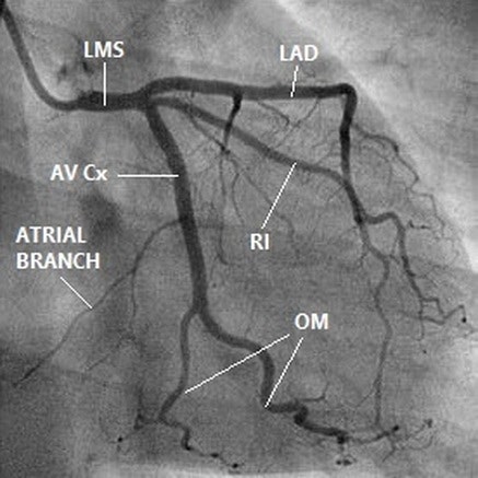 LAD, LCX, RCA 구분하는 법 ; coronary angiograpy 보는 법 : 네이버 블로그