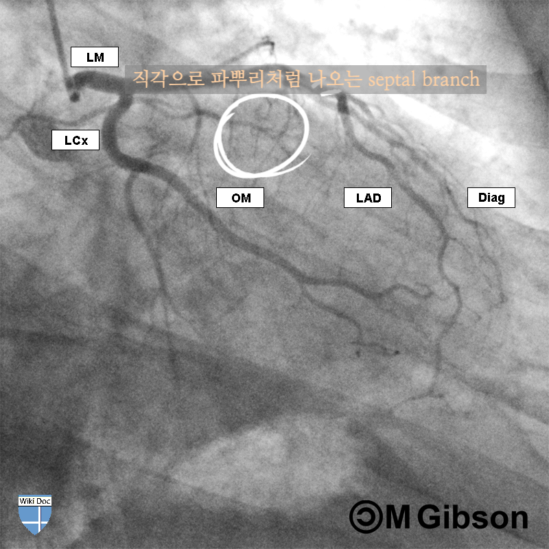 LAD, LCX, RCA 구분하는 법 ; coronary angiograpy 보는 법 : 네이버 블로그