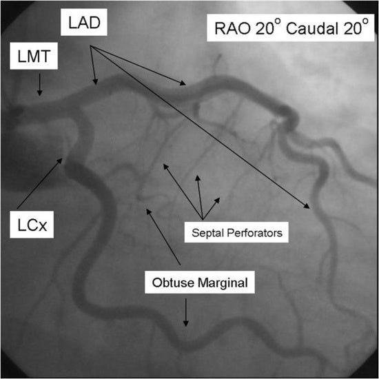 LAD, LCX, RCA 구분하는 법 ; coronary angiograpy 보는 법 : 네이버 블로그