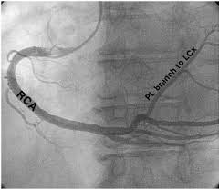LAD, LCX, RCA 구분하는 법 ; coronary angiograpy 보는 법 : 네이버 블로그
