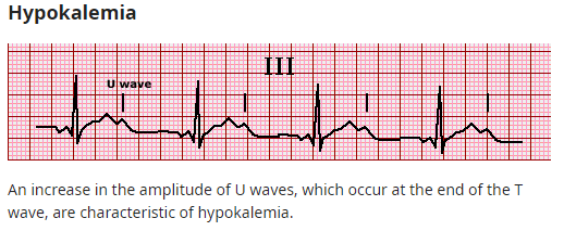 5. Hypokalemia(저칼륨혈증) management : 네이버 블로그