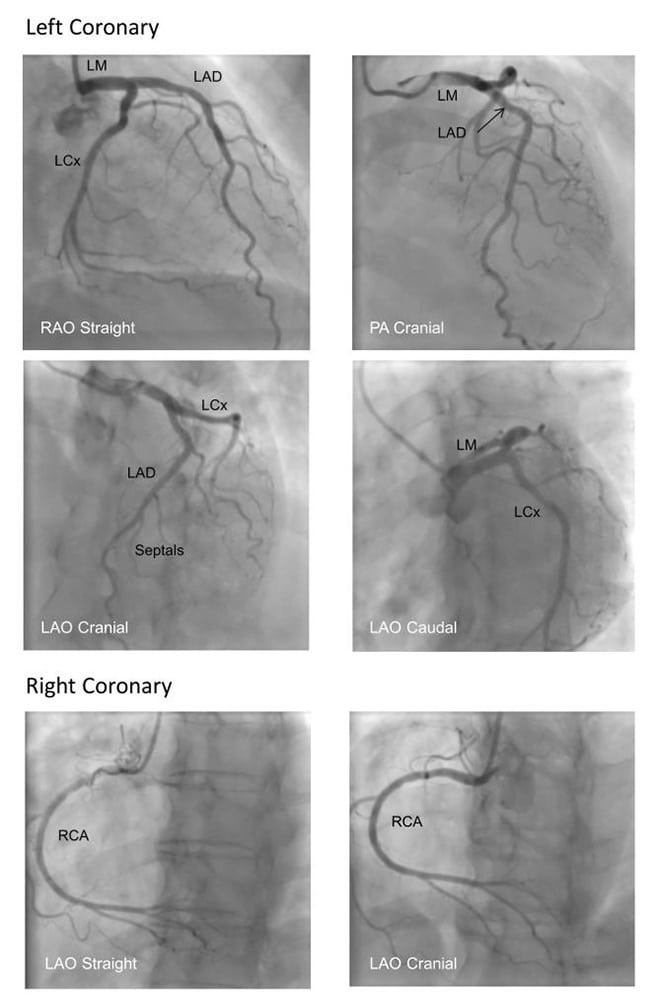 LAD, LCX, RCA 구분하는 법 ; coronary angiograpy 보는 법 : 네이버 블로그