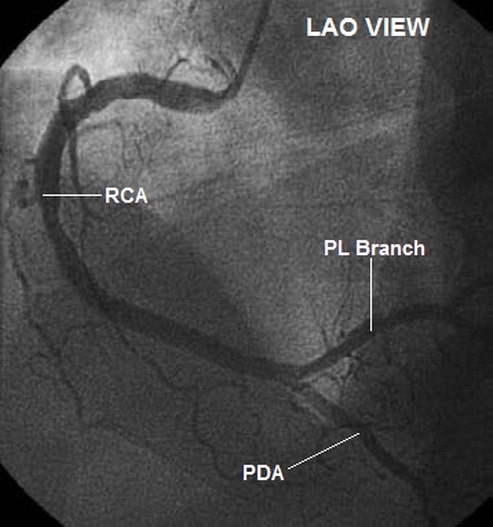 LAD, LCX, RCA 구분하는 법 ; coronary angiograpy 보는 법 : 네이버 블로그