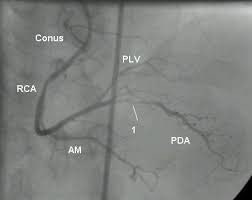 LAD, LCX, RCA 구분하는 법 ; coronary angiograpy 보는 법 : 네이버 블로그