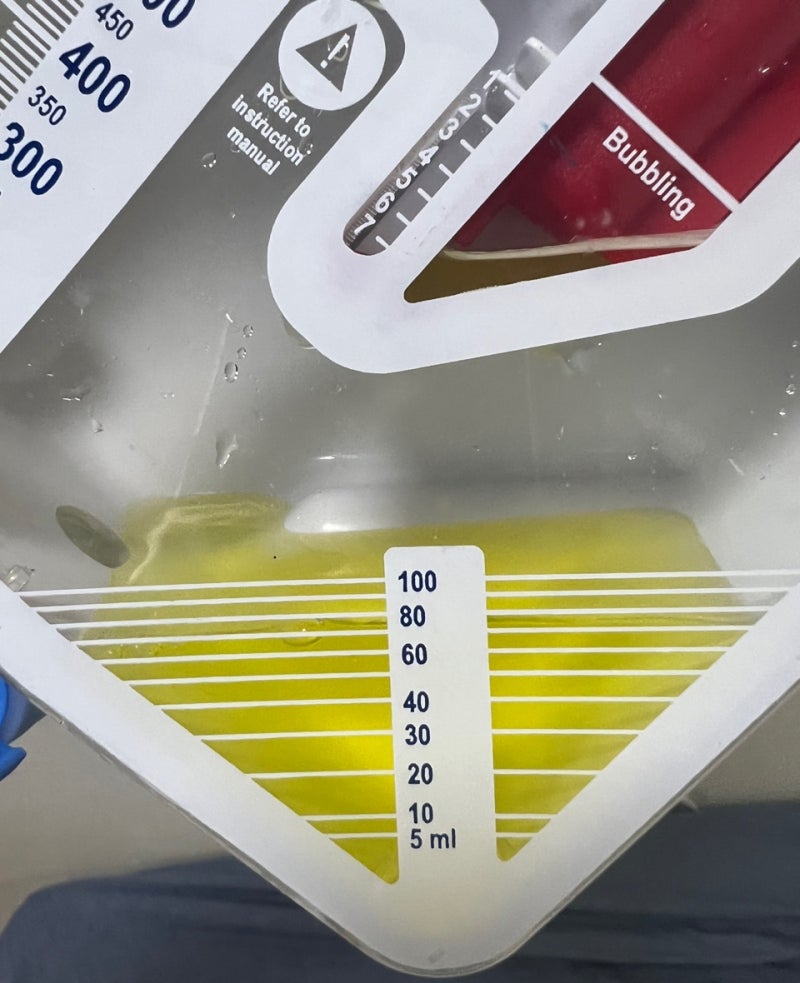 SINAPI Chest Bottle(시나피 체스트 보틀)에 대한 모든것(설명, 적응증, 설치, 장점, 임상적용) : 네이버 블로그