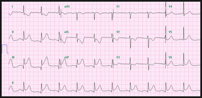 reverse EKG ; EKG 를 반대로 찍으라고? 왜? : 네이버 블로그