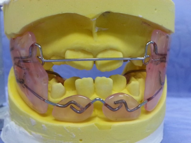 Frankel appliance/Function Regulator : 네이버 블로그