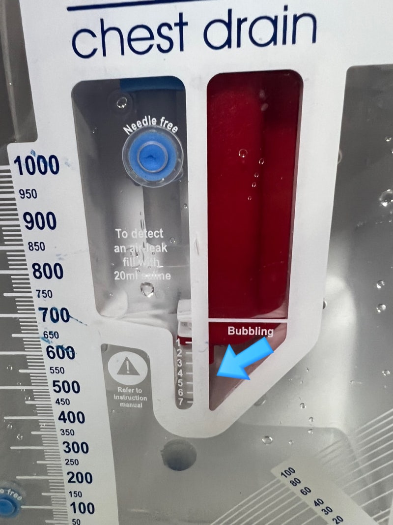 SINAPI Chest Bottle(시나피 체스트 보틀)에 대한 모든것(설명, 적응증, 설치, 장점, 임상적용) : 네이버 블로그