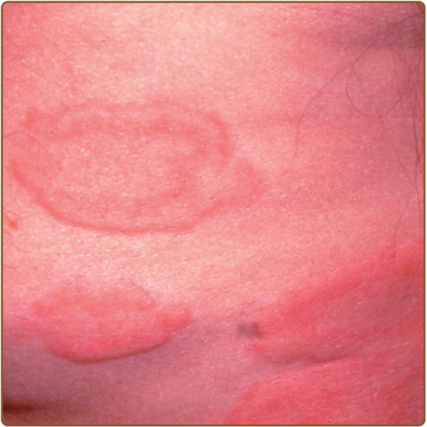 Erythema annulare centrifugum(EAC) : 원심고리홍반 : 네이버 블로그