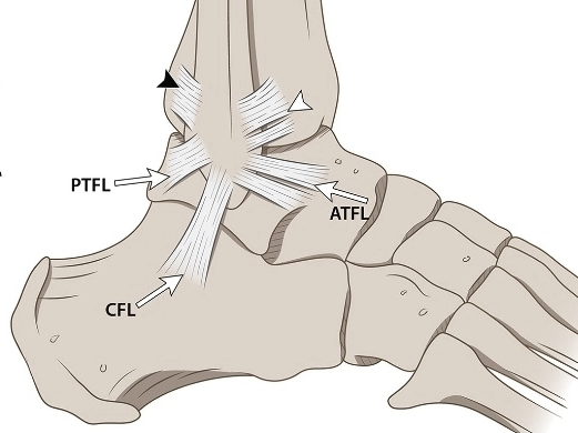 ATFL/ CFL Rupture : 네이버 블로그