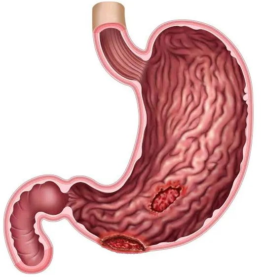 위궤양 약 알마겔 무코스타정 케이캡정 비교 【위궤양 증상 위궤양 치료 위궤양 원인 위염약 위염 알마겔정