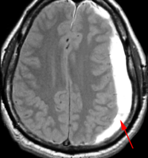 EDH & SDH&IVH&SAH&ICH : 네이버 블로그
