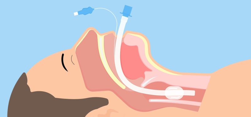 Intubation 방법, 준비물, 목적 : 네이버 블로그