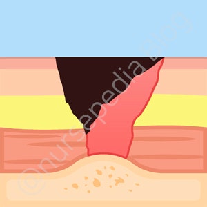 욕창단계사정 Stage 별 특징 (+Unstageable, SDTI) : 네이버 블로그