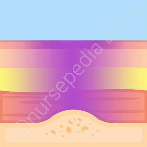 욕창단계사정 Stage 별 특징 (+Unstageable, SDTI) : 네이버 블로그