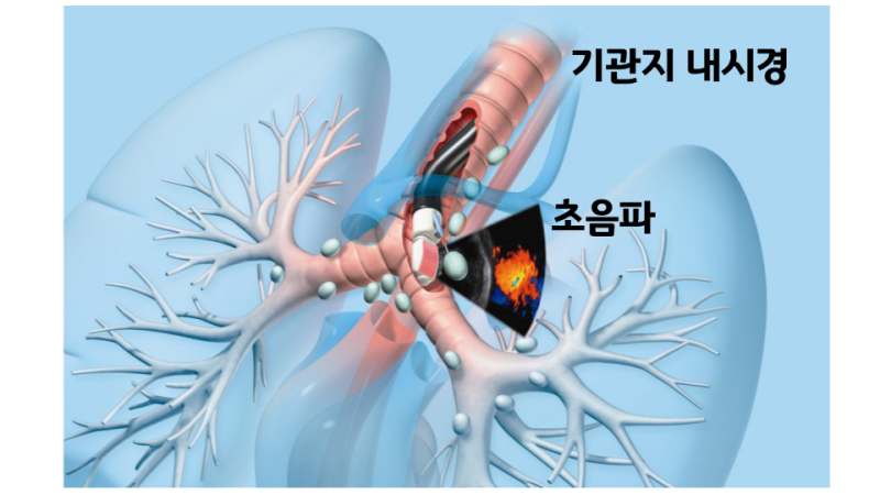 폐 조직 검사 폐암은 아닌지 확인하기 네이버 블로그