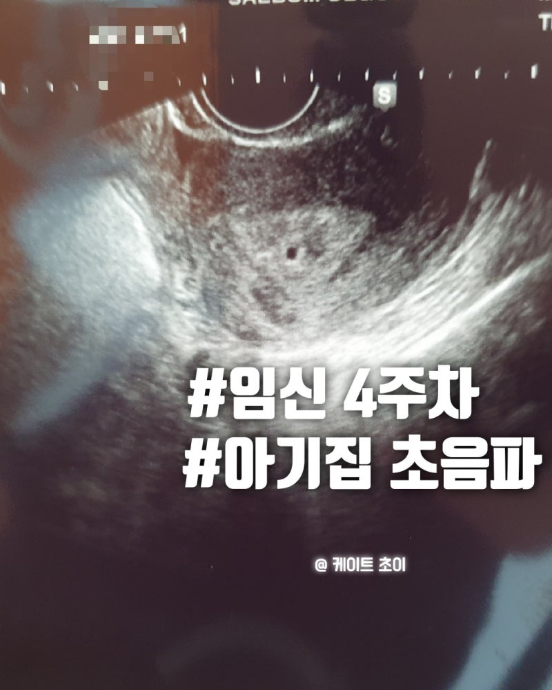 임신 4주차 초음파 검사아기집 확인 진찰비용 임테기 임신확인서 국민행복카드신청 네이버 블로그