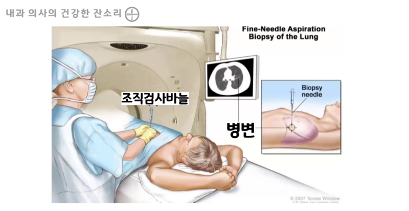 폐 조직 검사 폐암은 아닌지 확인하기 네이버 블로그