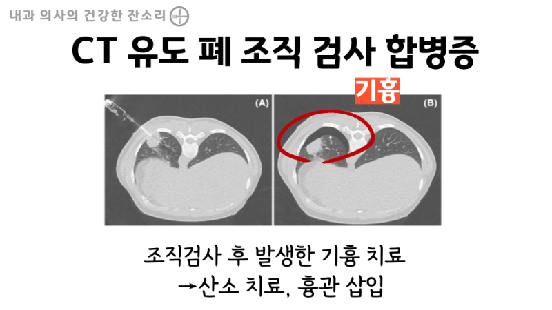 폐 조직 검사 폐암은 아닌지 확인하기 네이버 블로그