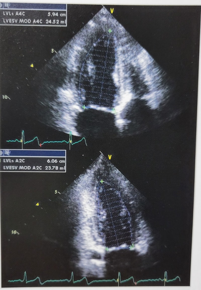 심장초음파 검사 완벽정리(알기 쉽게 알아보자) : 네이버 블로그